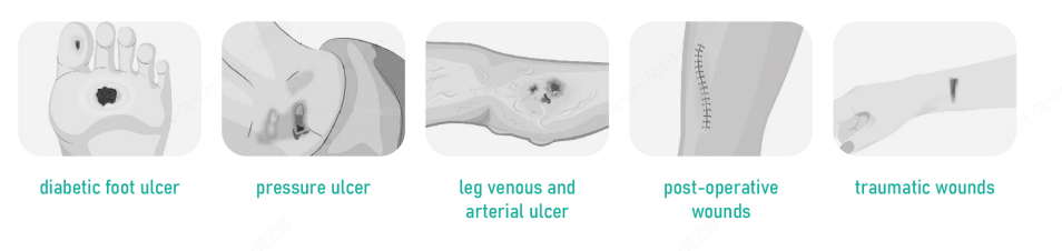 Super Absorbent Dressing - Winner Medical